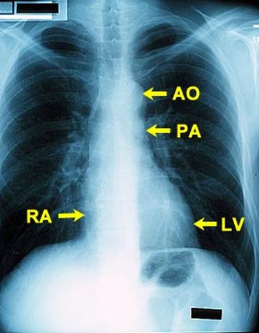 Normal Chest X-ray