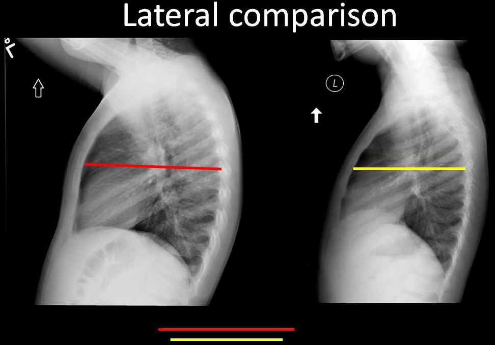 PBL Case 1310 Chest X-ray, Lateral, Comparison