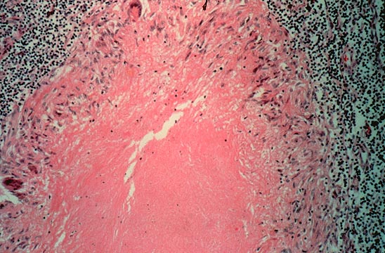 Tuberculosis - Micro